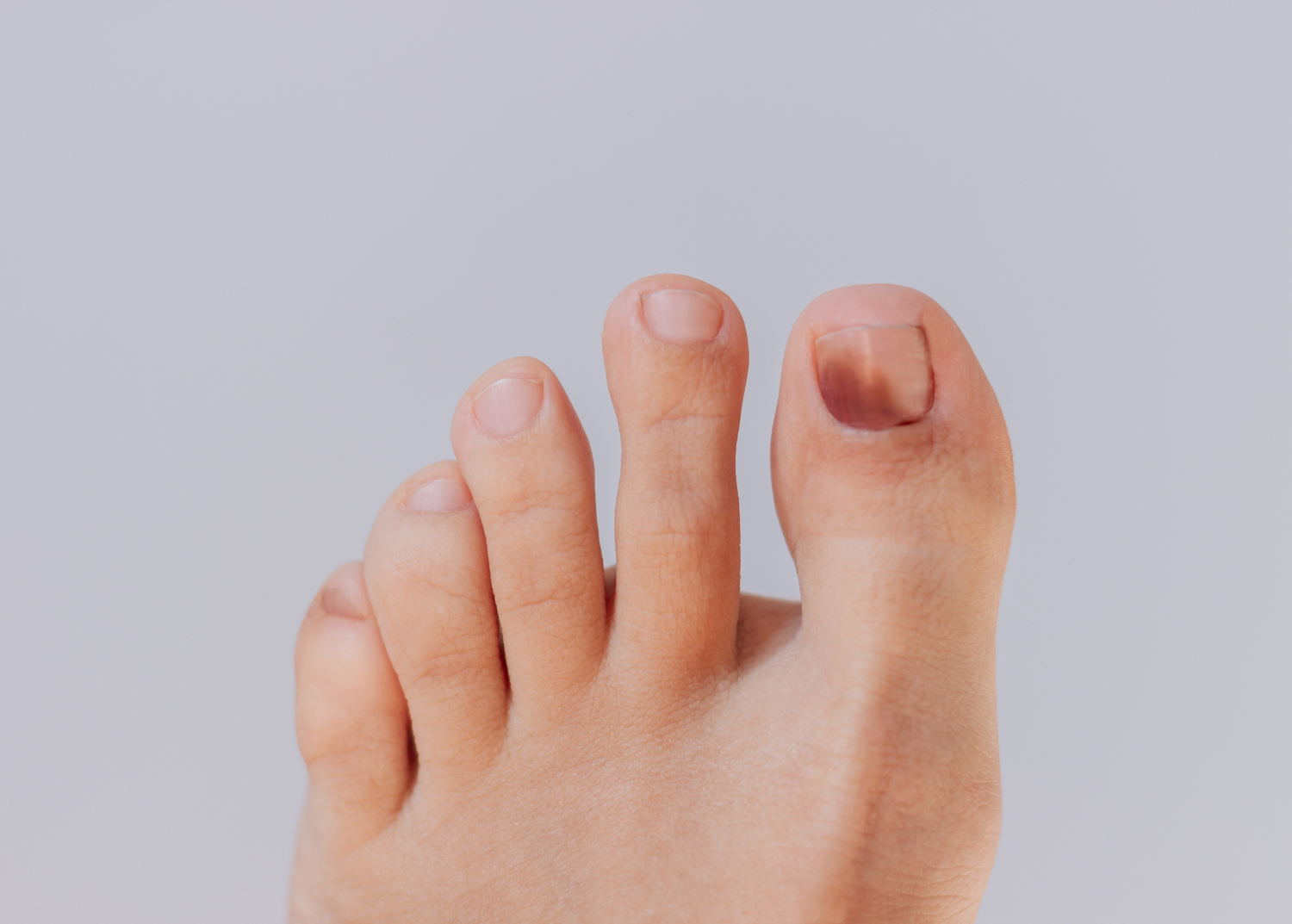 Psoriasis de l’ongle : définition, causes et traitements – PODERM®