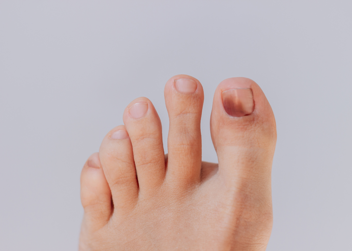 Psoriasis de l’ongle : définition, causes et traitements – PODERM®