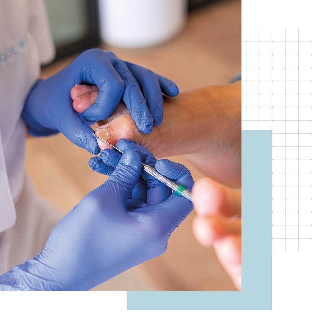 Mycose de l'ongle – PODERM®